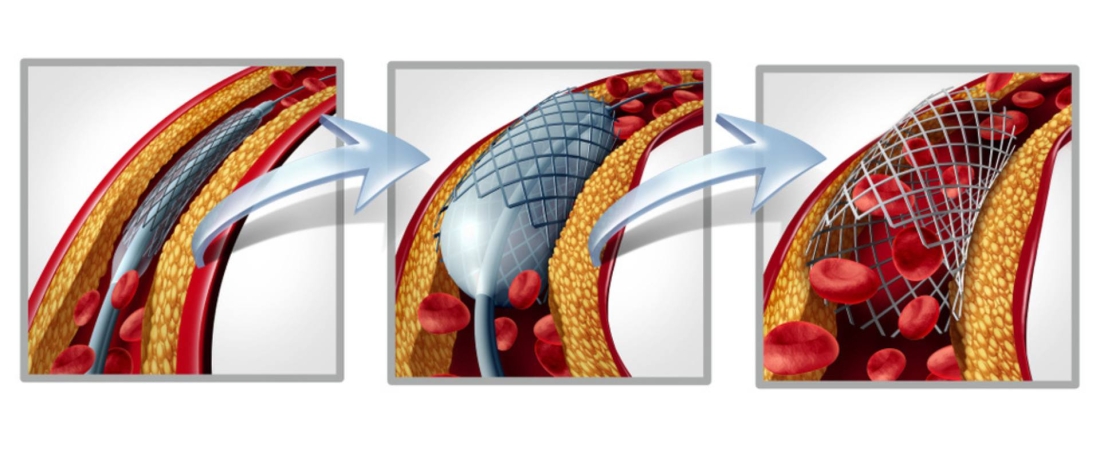 Αγγειοπλαστική και εμφύτευση stent | Διαδικασία